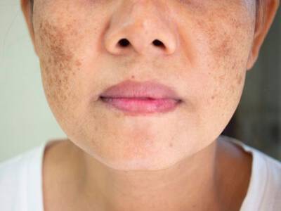 O que é hipercromia? Dermatologista esclarece dúvidas sobre manchas