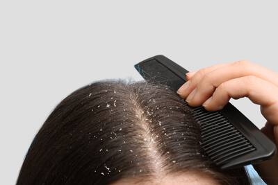 O que é bom para caspa? 5 cuidados que vão te ajudar a tratar!