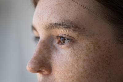 Manchas solares: como surgem na pele e como evitar?