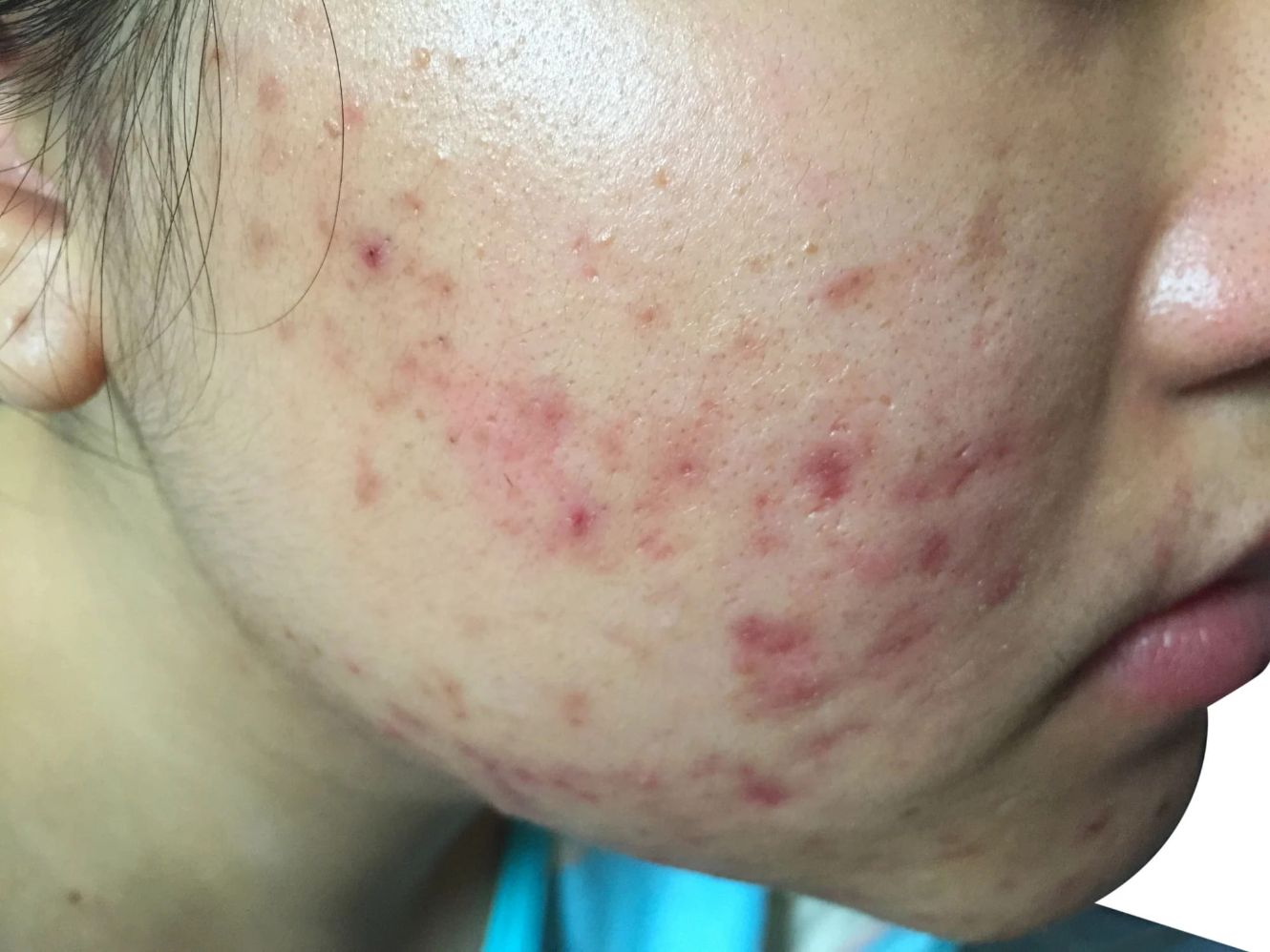 Acne: o que é, causas, sintomas, tratamentos e como evitar as espinhas ...
