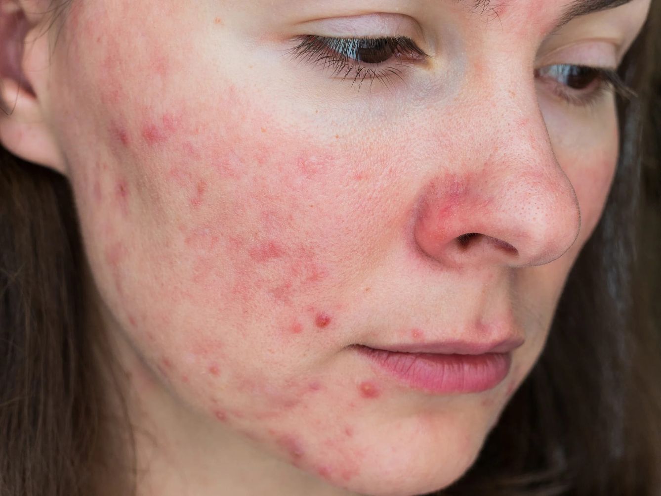 Acne: o que é, causas, sintomas, tratamentos e como evitar as espinhas ...