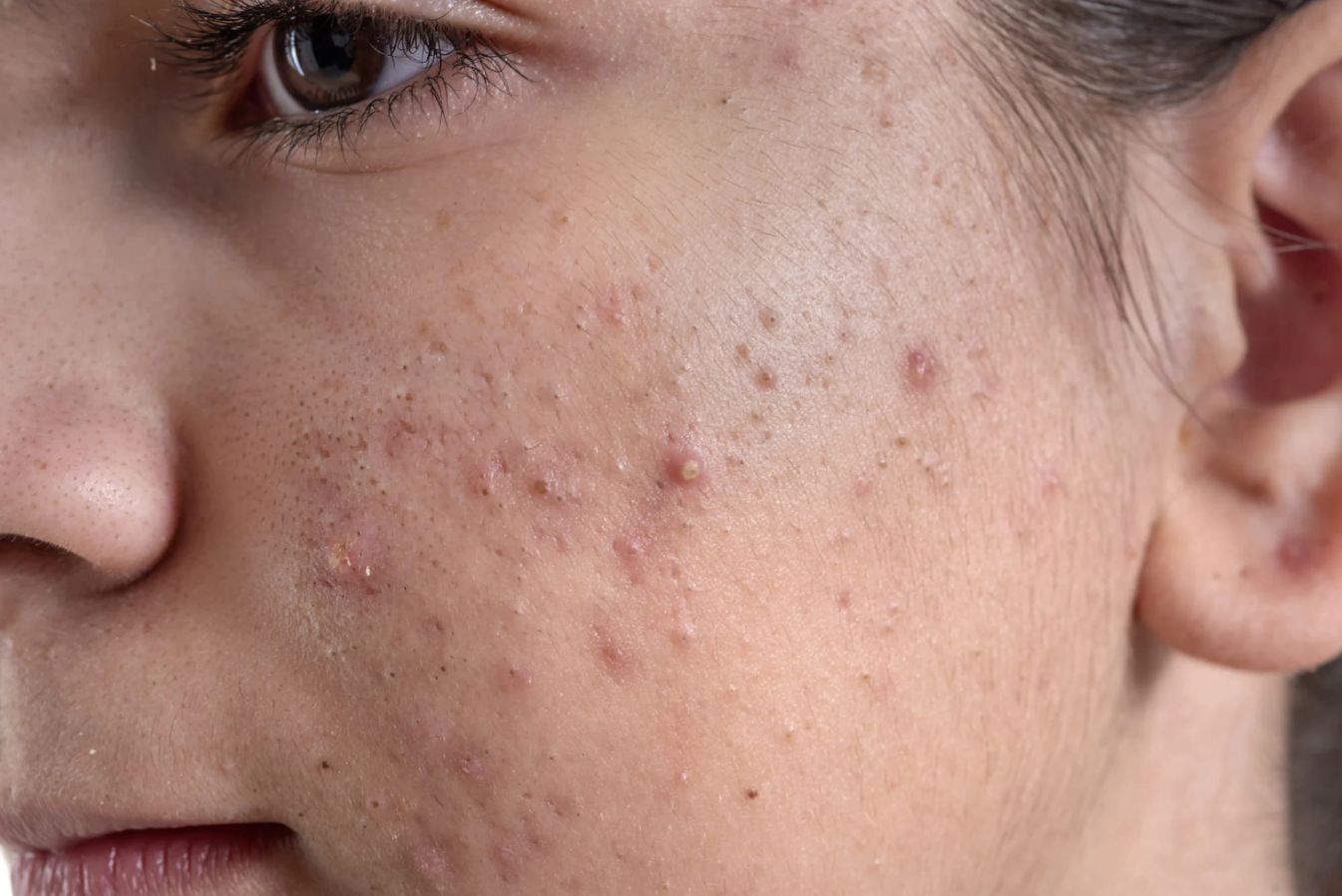 Mapa Da Acne: Entendendo Espinhas Em Diferentes Regiões Do Rosto