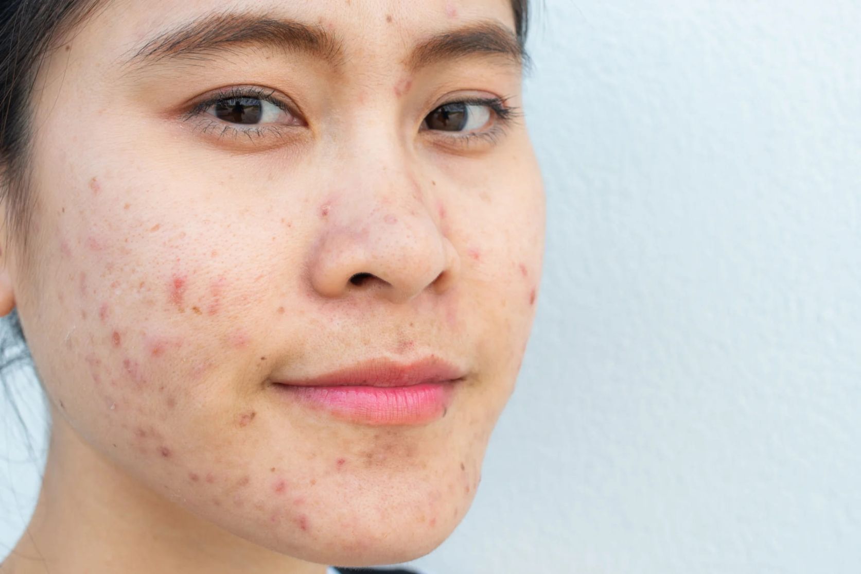 Acne: o que é, causas, sintomas, tratamentos e como evitar as espinhas ...