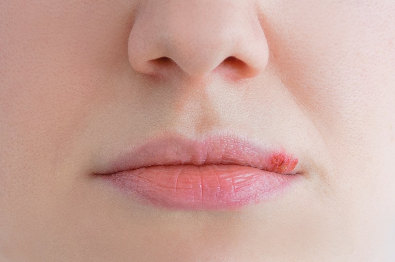 Herpes labial e herpes genital: saiba mais sobre as doenças ...