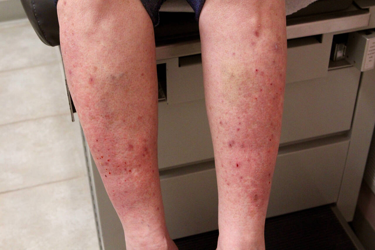 Dermatite Herpetiforme Doenca Celiaca Alguém Já Foi Diagnosticado