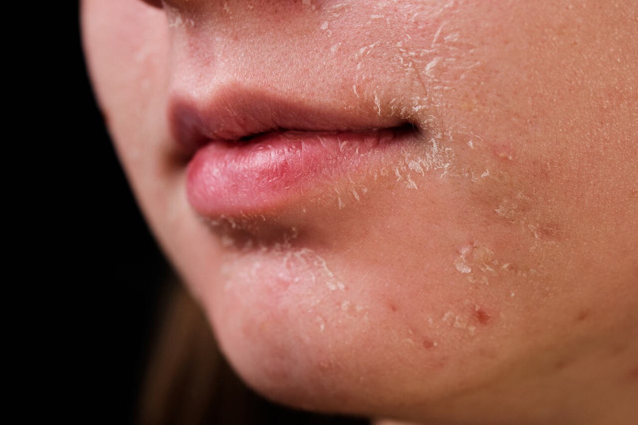 Dermaplaning: o que é, benefícios e contraindicações