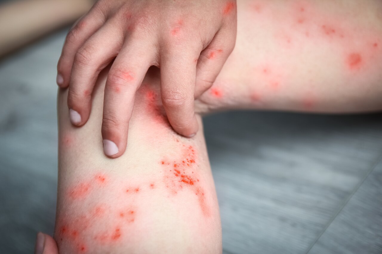 Pintas vermelhas na pele: o que podem ser e quando se preocupar