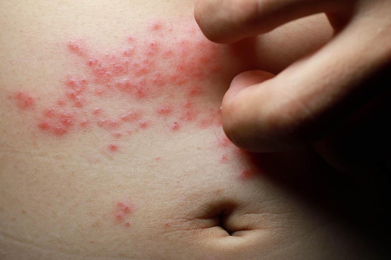 Manchas vermelhas no corpo: quais são os tipos e tratamento?